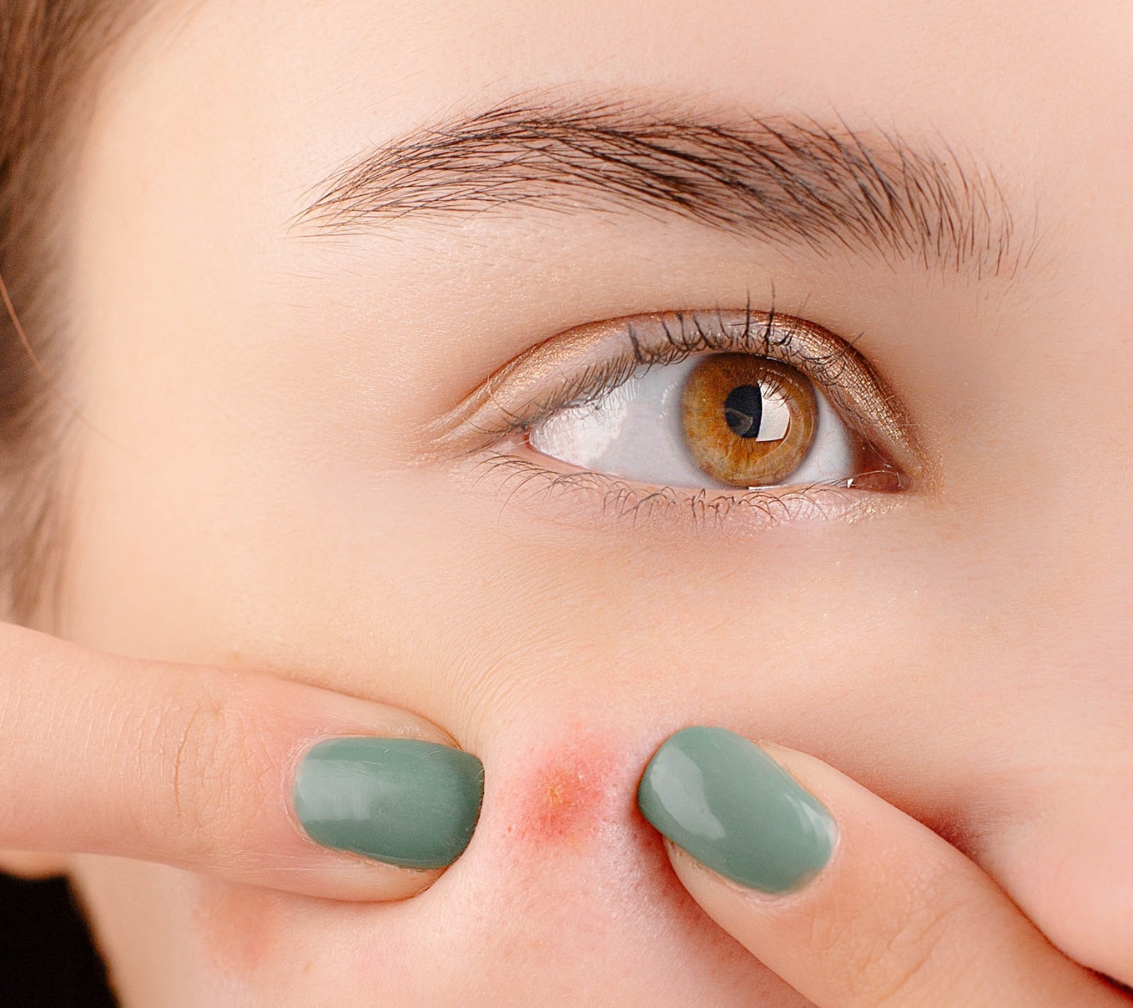 Ampuh! Begini Cara Menghilangkan Bekas Jerawat Secara Alami ...