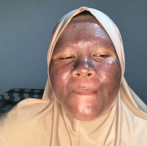 Wajah Gosong akibat Pemutih Viral di TikTok, Begini Kisahnya ...