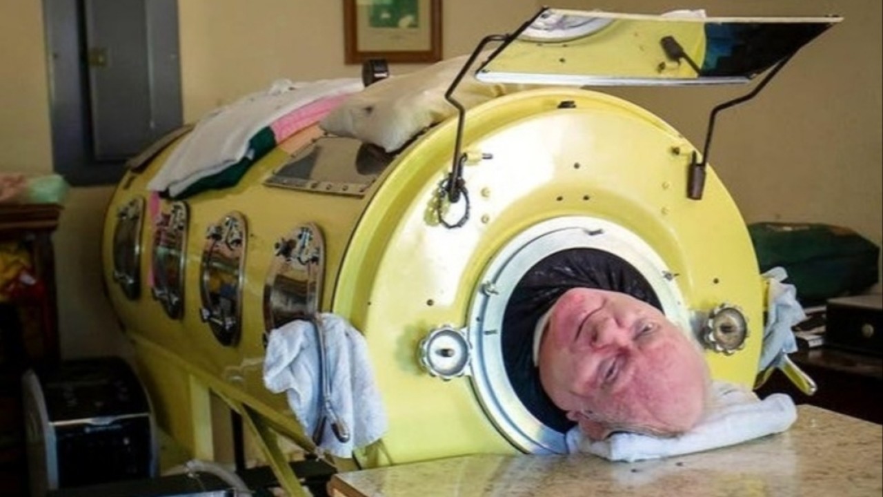Penyintas Polio Legendaris Paul Alexander Meninggal Dunia pada Usia 78 ...