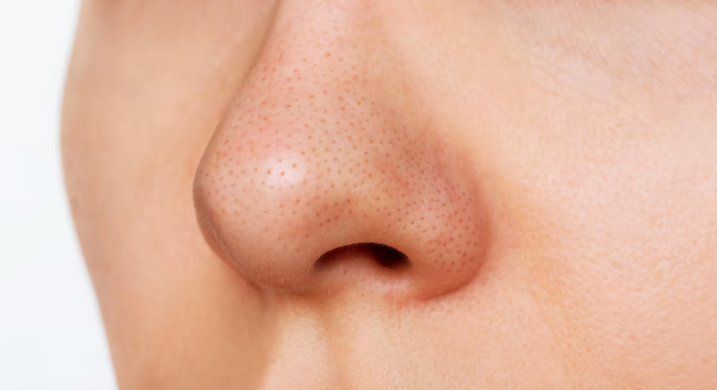 Cara Menghilangkan Komedo di Hidung, Sudah Coba? – jabarekspres.com