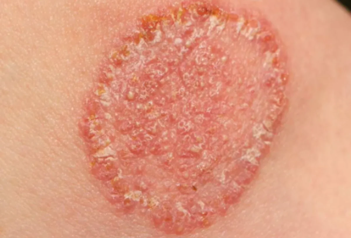 Obat Ampuh yang Terkena Ringworm atau Infeksi Jamur, Atasi Dengan Obat ...