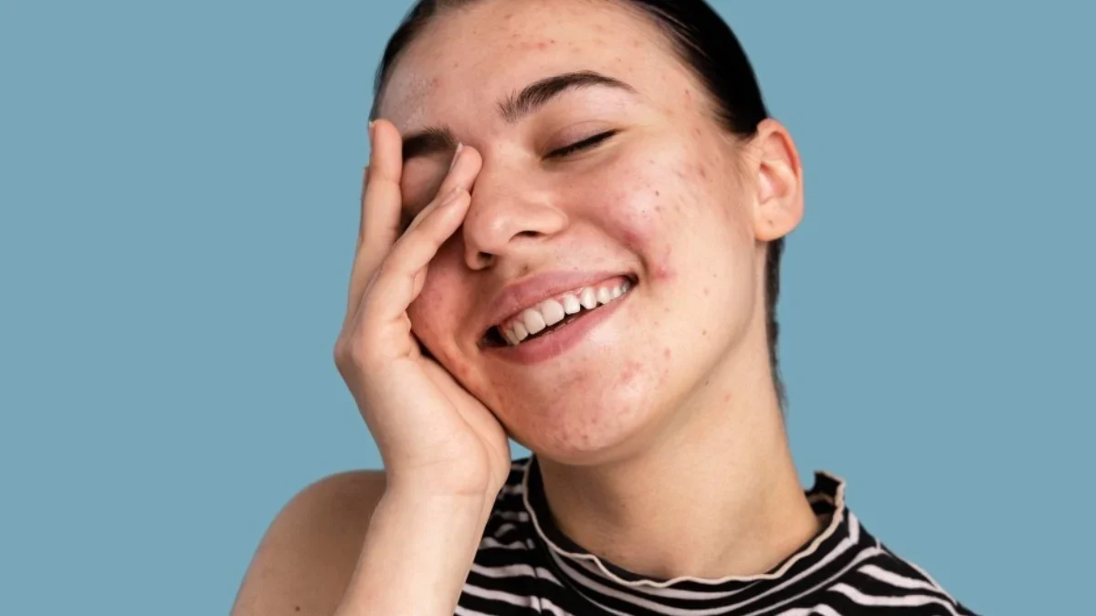 Simak Perbedaan Komedo Terbuka dan Komedo Tertutup serta Cara ...