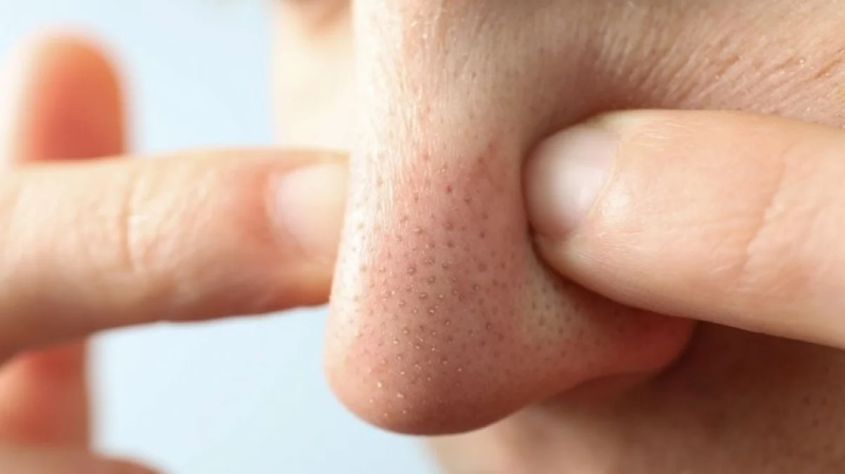 Beragam Cara Menghilangkan Komedo di Hidung dan Mencegah Munculnya ...