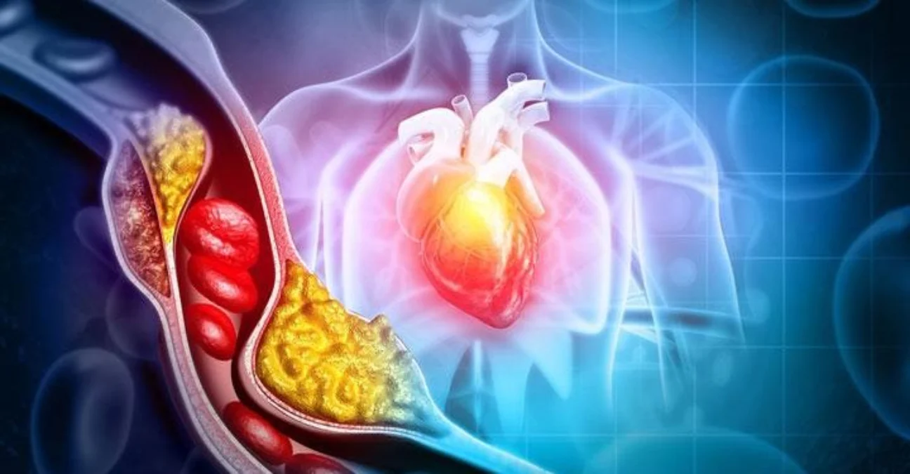 Kolesterol LDL dan Bagaimana Mengelolanya – Sumedang Ekspres