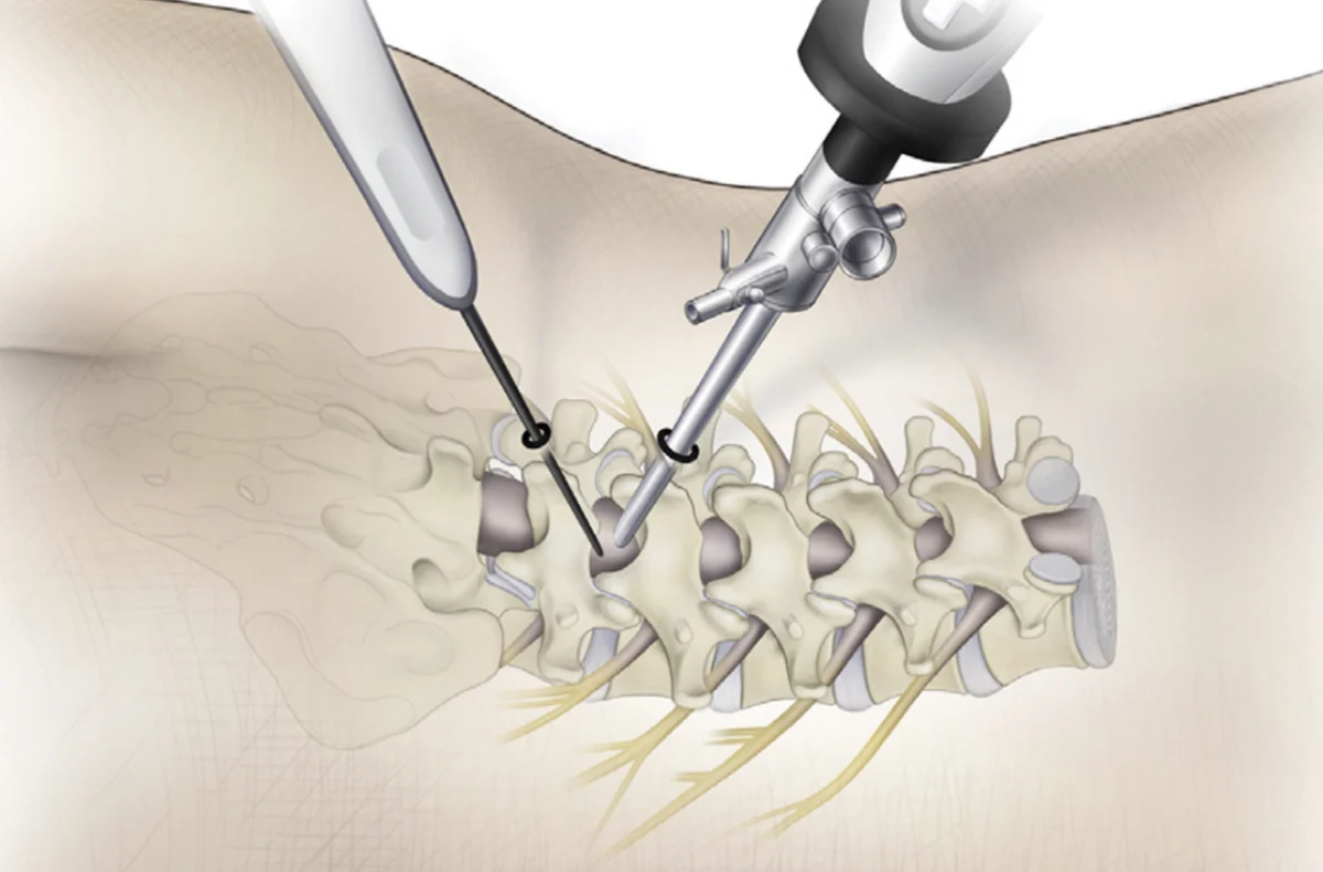 Bess Prosedur Bedah Tulang Belakang Menggunakan Teknik Endoskopi ...